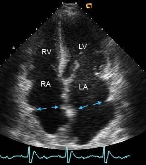 Advanced Heart Failure & Transplant Cardiology Fellowship | Division of Cardiology